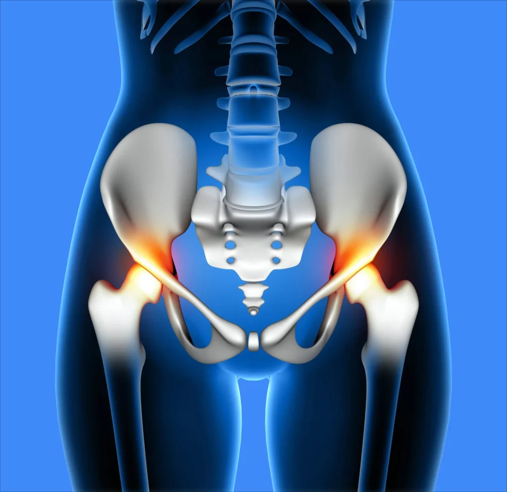 Œdème osseux hanche : causes, traitement et diagnostic IRM